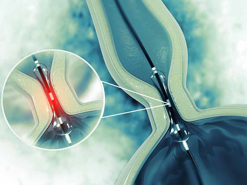 How Interventional Cardiology Can Treat Your Heart Conditions - Middle ...