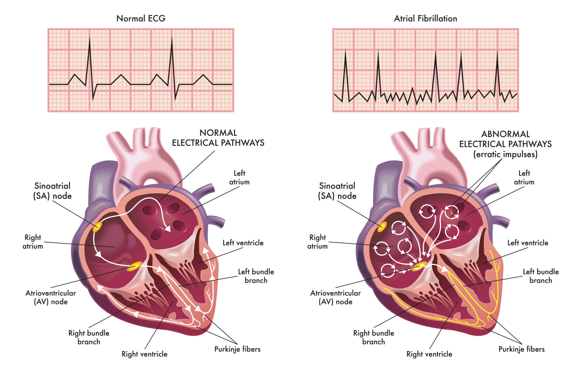 3 Questions to Ask Your Heart Doctor About Atrial Fibrillation